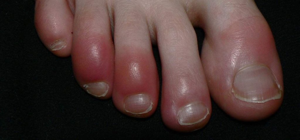 Chilblains Symptoms, Causes And Treatment Home Remedies