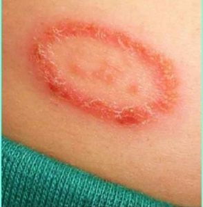Ringworm Rashes Symptoms , Causes And Treatments At Home