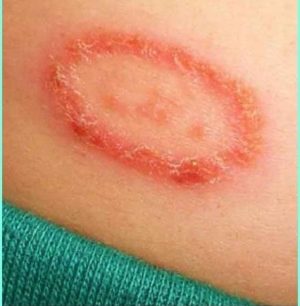Ringworm Rashes Symptoms , Causes And Treatments At Home